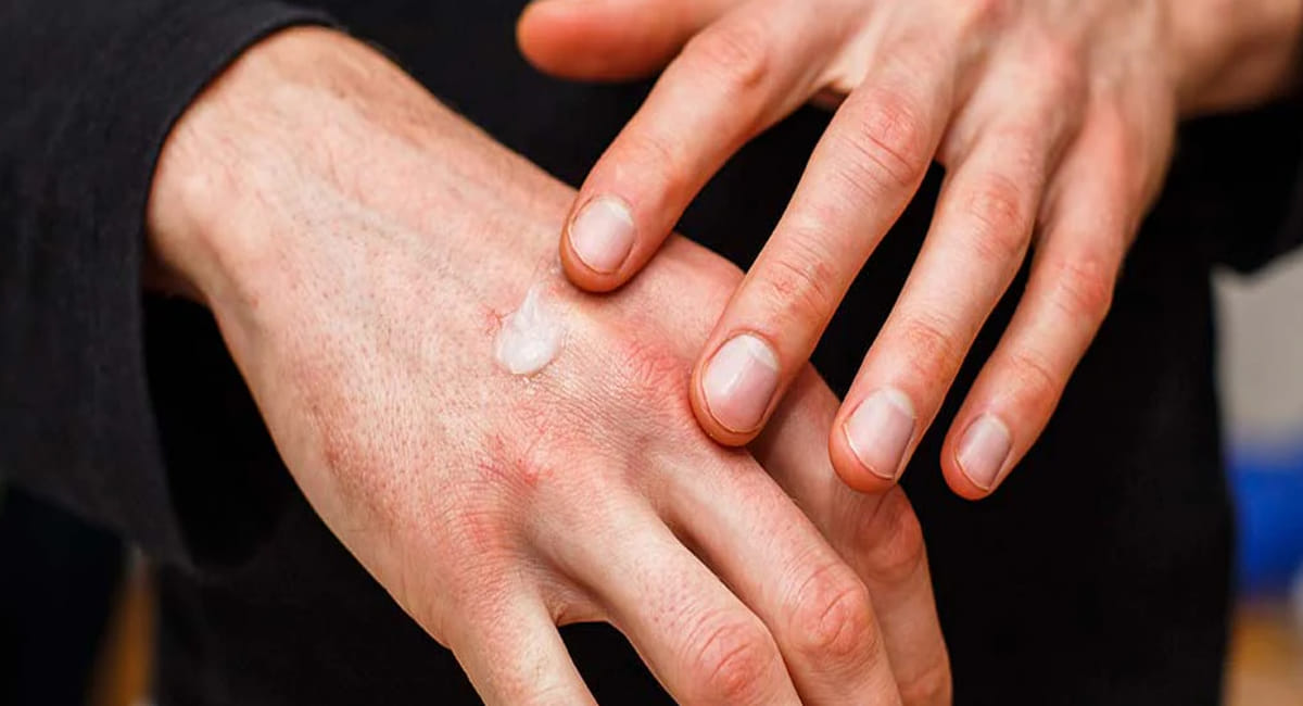 Dr Anjana | Topical Steroid Withdrawal (TSW)